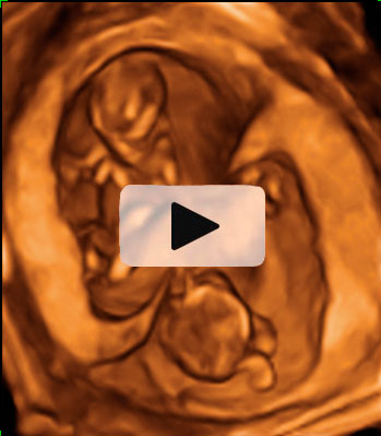 Ecografía 2D de la semana 12: Cuánto mide el feto