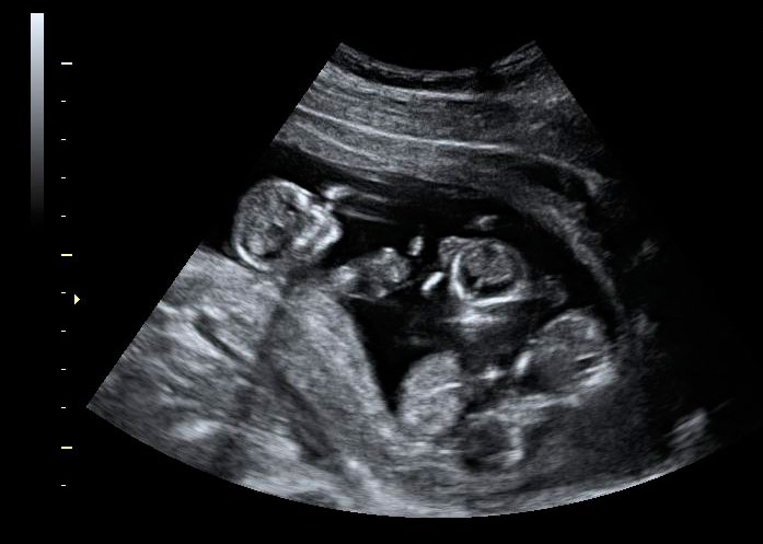 Ecografía 3D de la semana 12: Feto de perfil