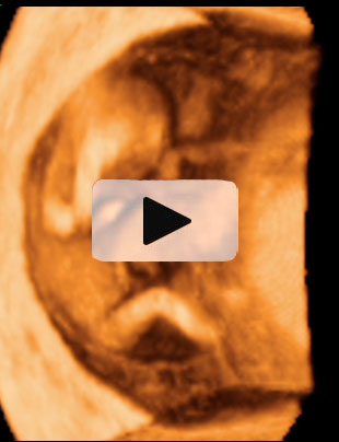 Ecografía 2D de la semana 12: Cuánto mide el feto